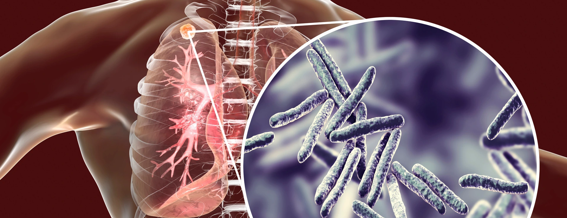 Post-tuberculosis lung disease: new approaches in prevention and treatment