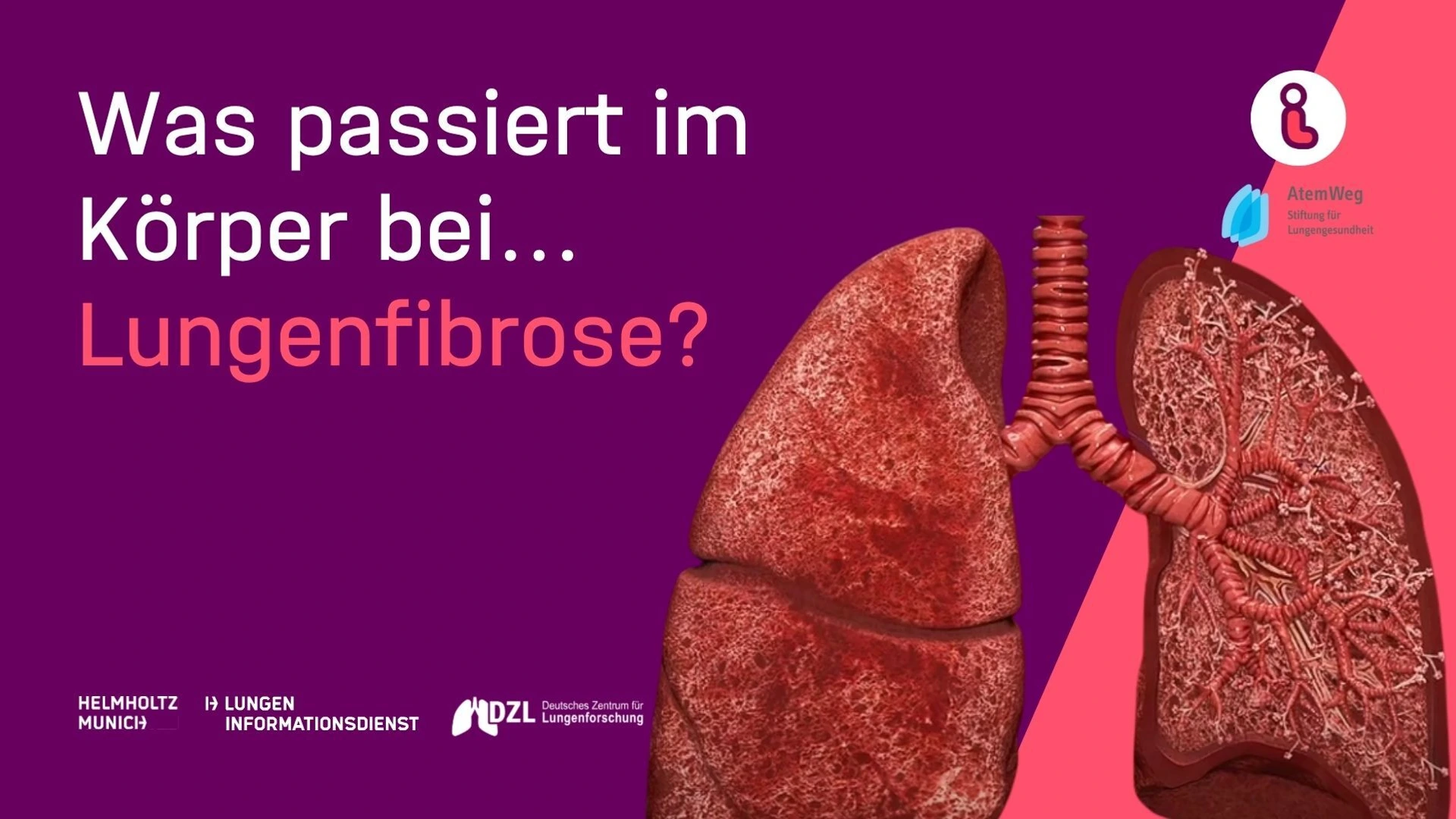 Lungenfibrose - Das Wichtigste im Überblick