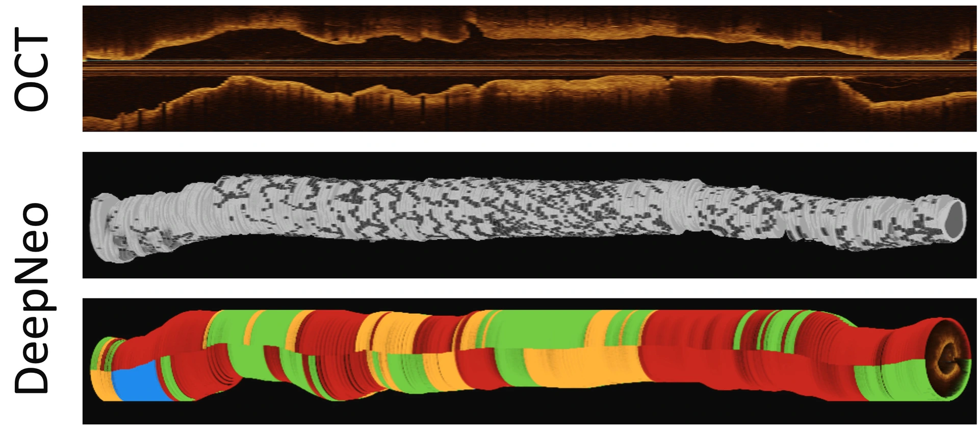 AI-Powered Analysis of Stent Healing